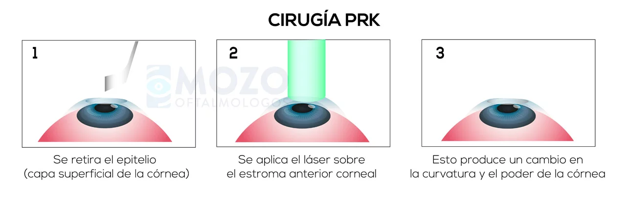 Cirugía refractiva: La solución para dejar de usar gafas - Mozo ...