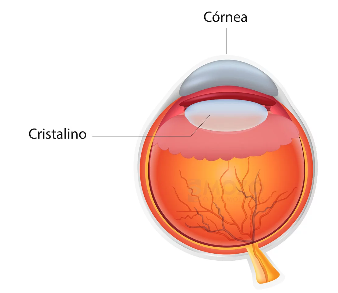 Cirugía refractiva: La solución para dejar de usar gafas - Mozo ...
