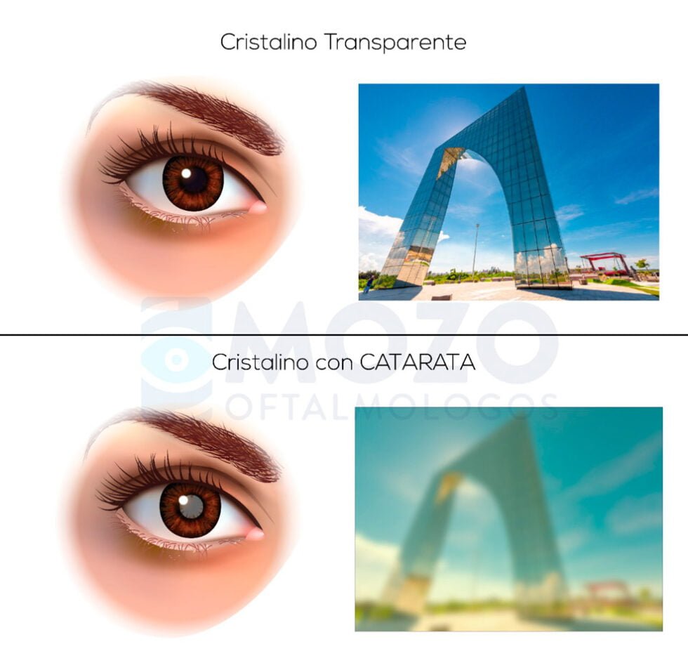 ¿Cómo puedo saber si tengo catarata y cómo se cura? - Mozo Oftalmólogos