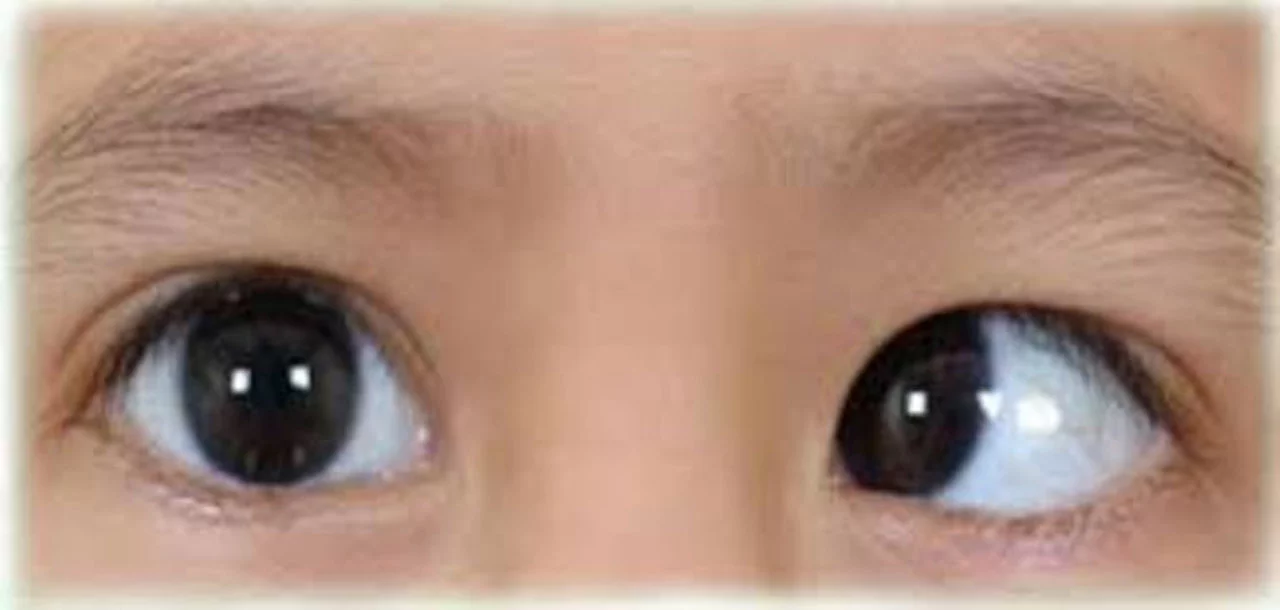 Estrabismo u ojos desviados… ¡Lo que debes saber! - Mozo Oftalmólogos