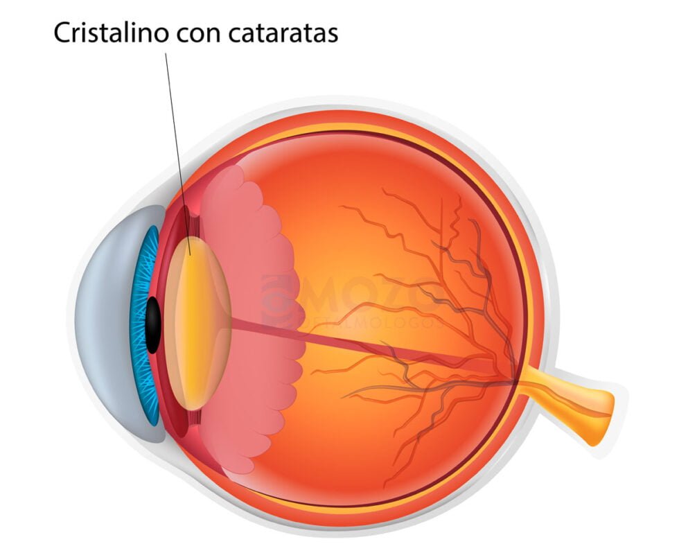 ¿Cómo puedo saber si tengo catarata y cómo se cura? - Mozo Oftalmólogos