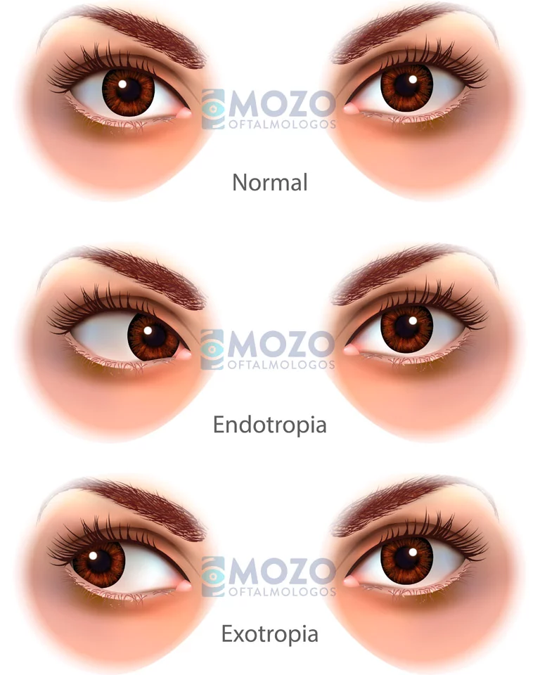 Estrabismo u ojos desviados… ¡Lo que debes saber! - Mozo Oftalmólogos